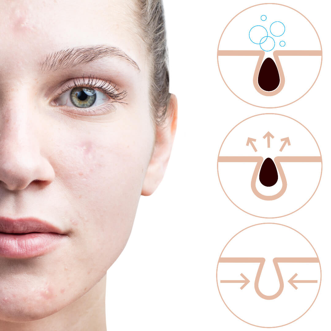 Pickel, Akne & unreine Haut Produkte online kaufen – GLAMcosmetic